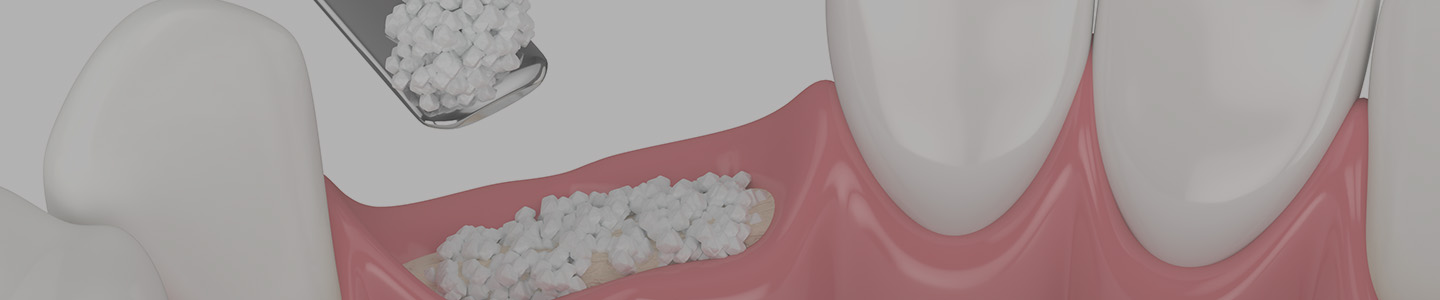 Dental Bone Grafting in Brentwood, TN | Wesley Dentistry